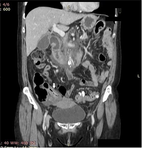Ct Scan Of Abdomen And Pelvis Showing Diffuse Fusiform Thickening Of