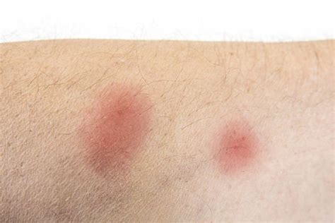 How To Deal With A Spider Bite Venomous Spider Bites On Rise In