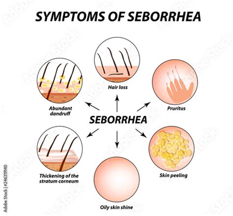Symptoms Of Seborrhea Seborrhea Skin And Hair Dandruff Seborrheic