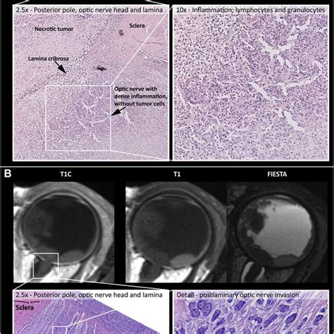The Magnetic Resonance Imaging Mri Pathological Correlations Of