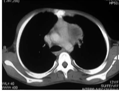 Contrast Enhanced Computed Tomography Of Chest Showing Necrotic Thick
