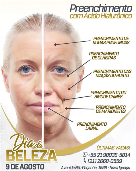 Preenchimento Facial Com Ácido Hialurônico Veja O Que Um Tratamento