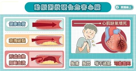 壞膽固醇超標怎麼辦？心臟名醫教你「做1件事」延緩血管老化速度 蕃新聞