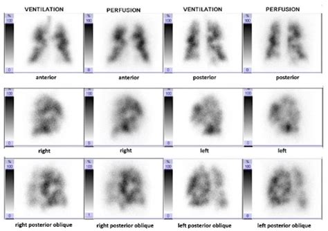 Planar V Q Scan Showing Multiple Perfusion Defects Matched With