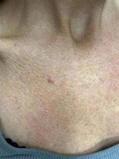 Dermdx New Growth On Chest Clinical Advisor