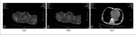 Figure 3 From Bilateral Insufficiency Fracture Of Coracoid Process A