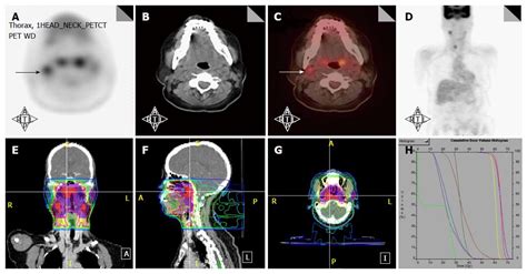 Radiation Therapy For Head And Neck Cancer All About Radiation