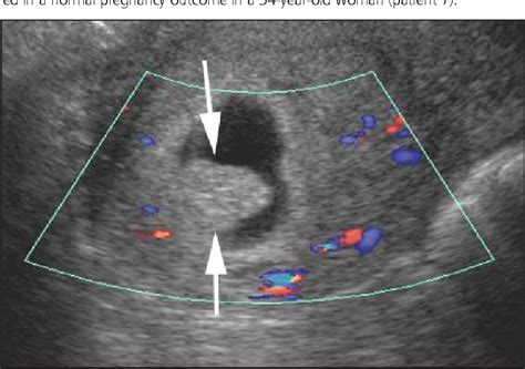 Figure 2 From The Chorionic Bump A First Trimester Pregnancy