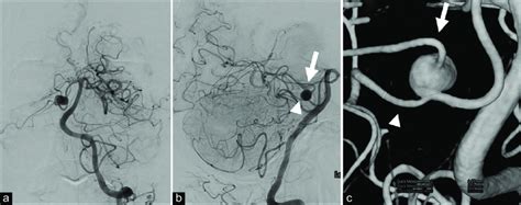 Imaging Before The Procedure A Dsa Frontal View B Dsa Lateral