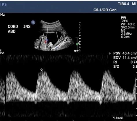 Lesson 16 Part 2 Doppler Flashcards Quizlet