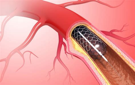 What Is Arterial Revascularization Usa Vascular Centers