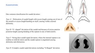 Caudal Devation Correctionpptx