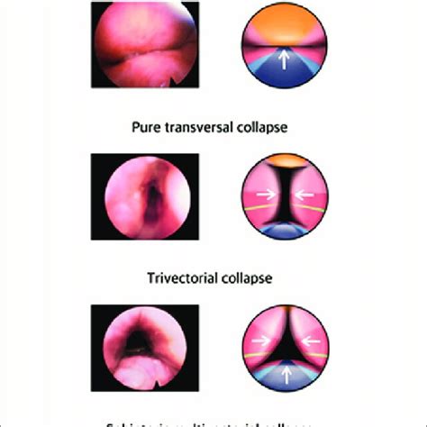 Vectorial Classification Of Palatopharyngeal Collapse Patterns V