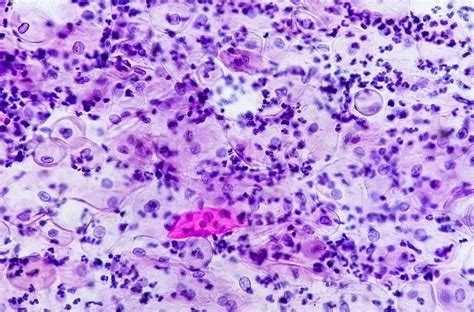 Paps Smear Microscopic Examination Of Pap Smear Showing Inflammatory