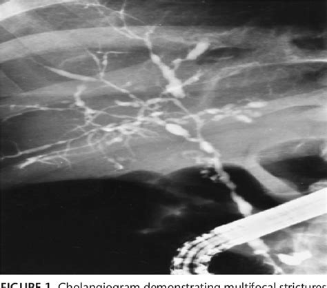 Table 2 From Primary Sclerosing Cholangitis Semantic Scholar