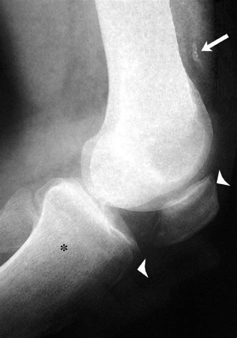 Quadriceps Tendon Calcification