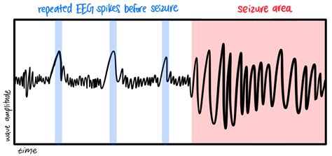 Seizure Observation And Preemptive Detection With Ml Comparing Eeg Based