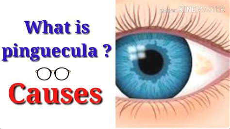 What Is Pinguecula Causes Clinical Features Complication