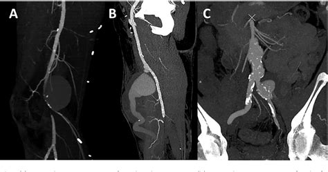 figure 1 from multiple concomitant arterial aneurysms in behçet s