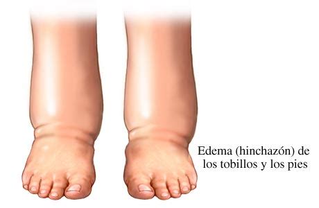 Edema Maleolar Cigna