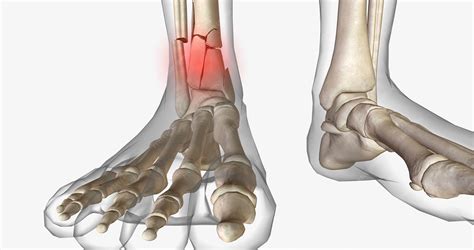 Premium Photo Distal Tibia Fractures Affect The Ankle Joint And Can Often Involve A Fracture