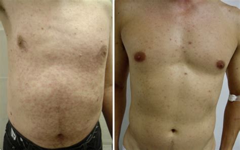 Sexually Acquired Syphilis Journal Of The American Academy Of Dermatology