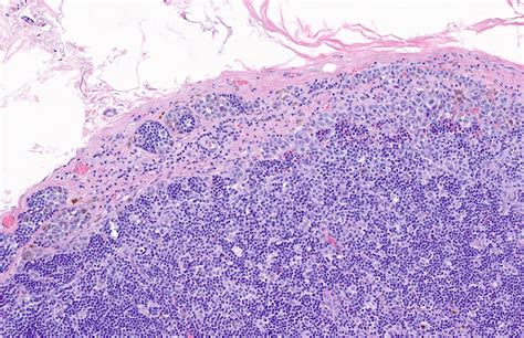Nodular Melanoma Pathology Outlines