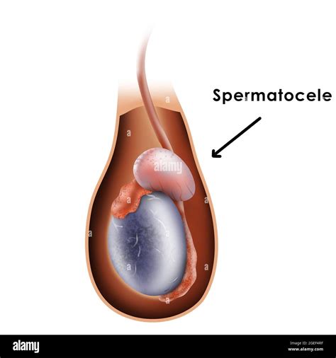 Testicular Spermatocele