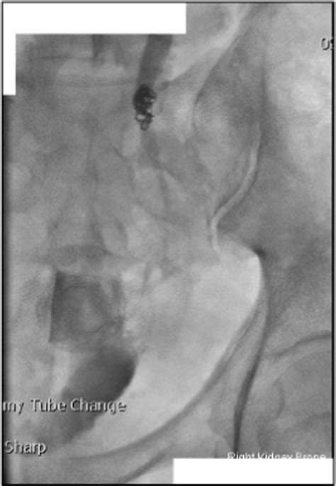 Repeat Nephrostogram Demonstrating Contrast Bypassing Coilglue Pack