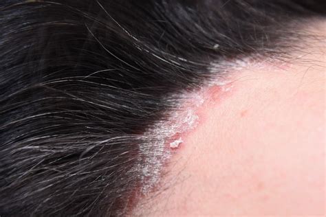 Scalp Psoriasis Pictures Symptoms And Treatment