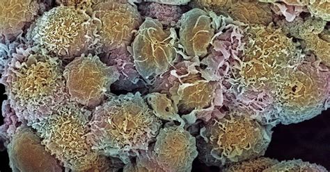 Cáncer De Mama Descubren En Qué Momento Del Día Los Tumores Aceleran