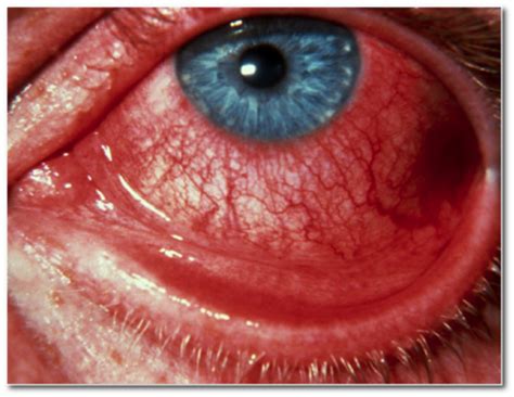 Intro To Eye Flashcards Quizlet