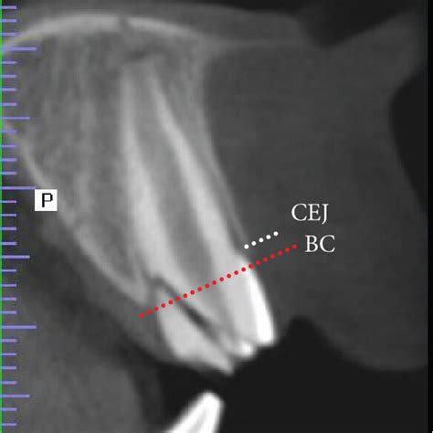 Sagittal Cbct Views Of A 11 And B 21 Showing Multiple Fracture