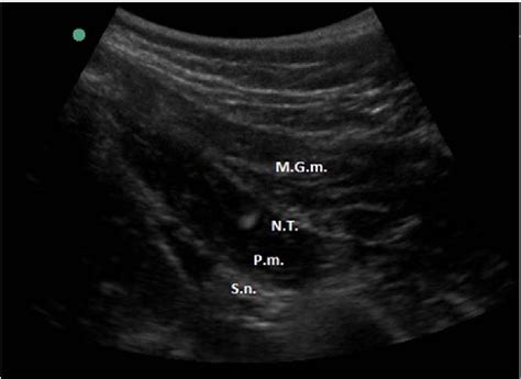 Piriformis Syndrome Ultrasound