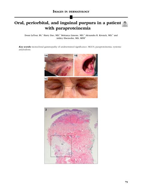 Pdf Oral Periorbital And Inguinal Purpura In A Patient With