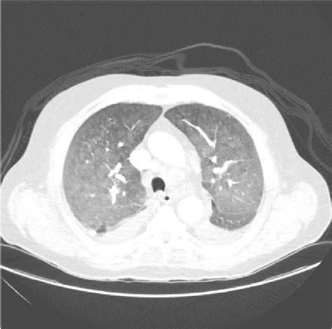 Figure 1 From Metastatic Pulmonary Calcification In A Renal Transplant Recipient Semantic Scholar
