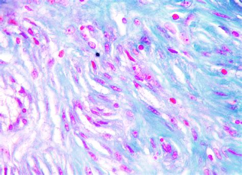 Canine Cutaneous Fibrosarcomaarea With Dense Conjunctive Fibers And