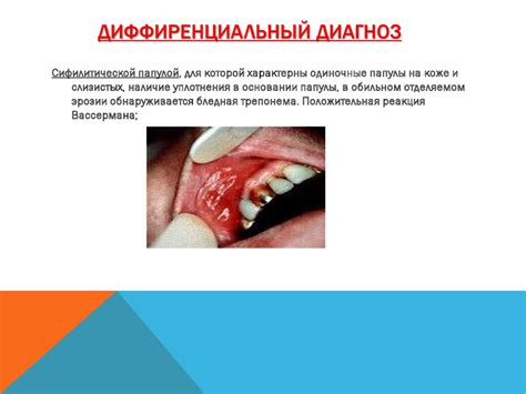 Кандидоз полости рта у детей презентация онлайн