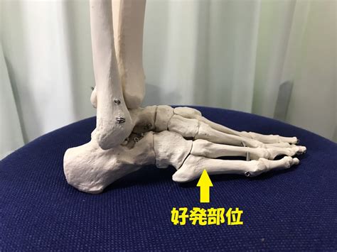 ジョーンズ骨折 足の第5中足骨疲労骨折 について 整骨院鍼灸院アシスト