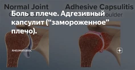 Боль в плече Адгезивный капсулит “замороженное” плечо Rheumatodoc Дзен