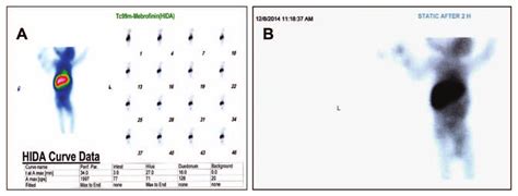 Hepatobiliary Iminodiacetic Acid Hida Scan Showed Intense