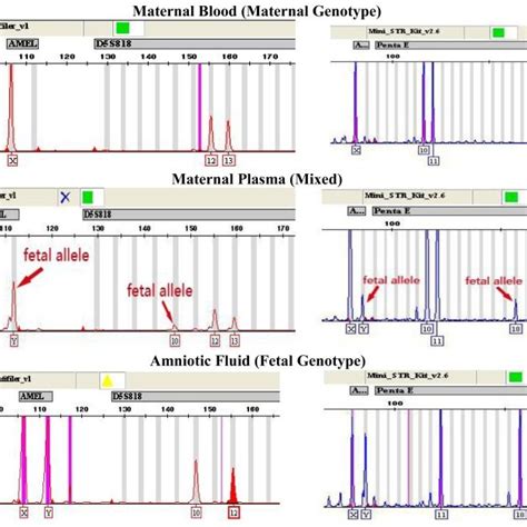 Y Str Genotyping Of Dna From Maternal Plasma With A Male Fetus 16
