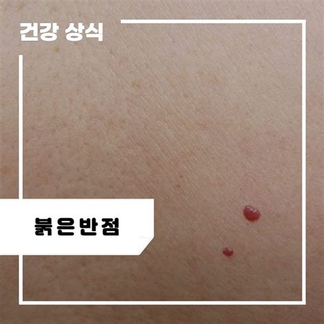 피부 붉은반점 원인과 증상 얼굴 손바닥 몸에 빨간점 네이버 포스트