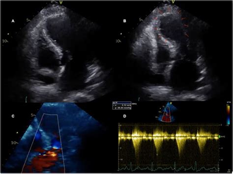 Dynamic Left Ventricular Outflow Tract Gradient Resulting From
