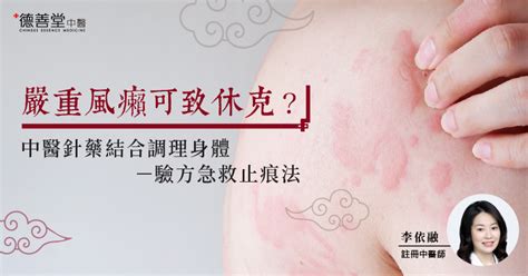 嚴重風癩可致休克？ 中醫針藥結合調理身體 － 驗方急救止痕法 中醫專欄 德善堂中醫