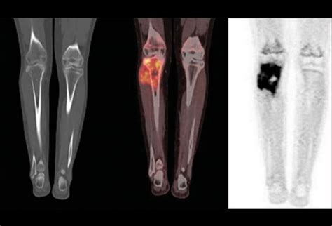 Sarcoma De Ewing Vs Osteosarcoma