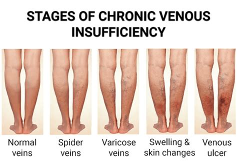 Chronic Venous Insufficiency Cvi