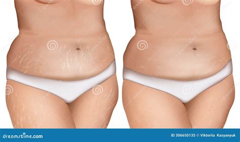 Stretch Marks On Hip And Thigh Illustration Isolated On White