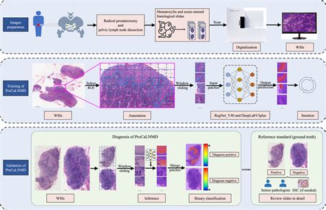 An Artificial Intelligence Model For Detecting Pathological Lymph Node Metastasis In Prostate