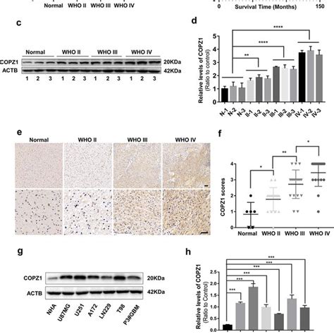 COPZ1 Expression Is Elevated In Primary Human Glioma Samples And GBM
